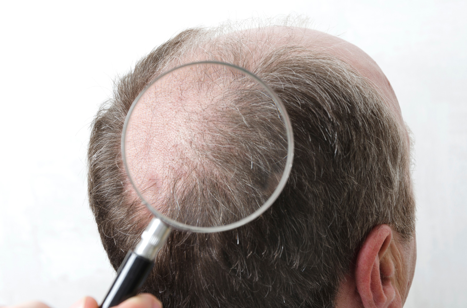 Androgenetic Alopecia – When Genetics Plays Tricks - DR ART CLINIC Polska